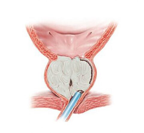 Χειρουργική μέθοδος HoLEP - Dr Αθανάσιος Βούλγαρης MD,PhD,FEBU